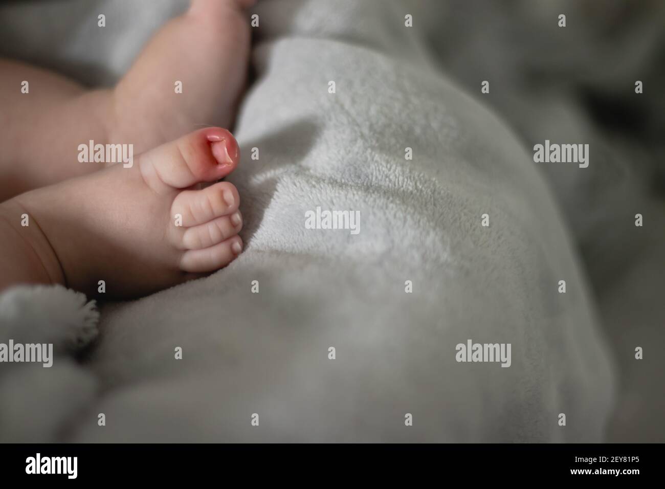 Close up view of ingrowing nail on the baby toe with signs of ...