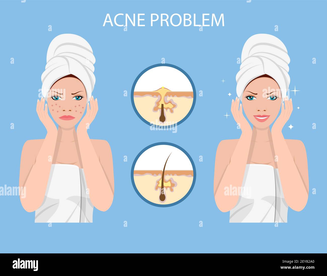Face with acne Stock Vector Image & Art - Alamy