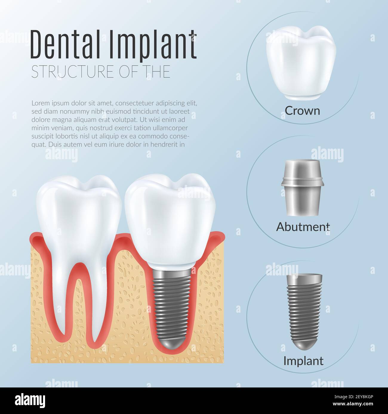 Structure of dental prosthetics infographics poster with denture near ...