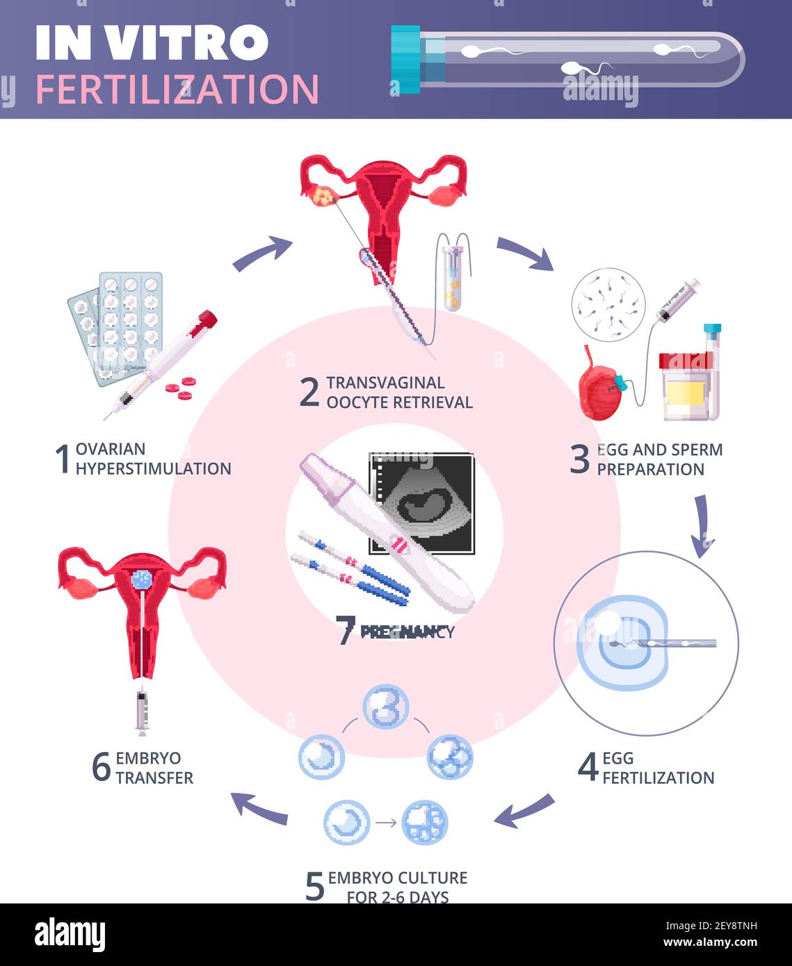 In Vitro Fertilization Diagram