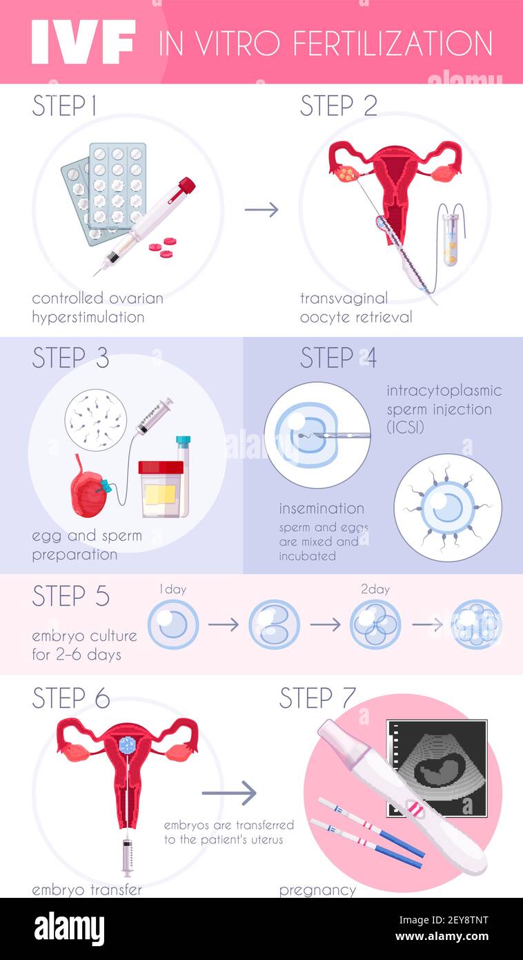 Colored flat in vitro fertilization IVF infographics with steps for ...