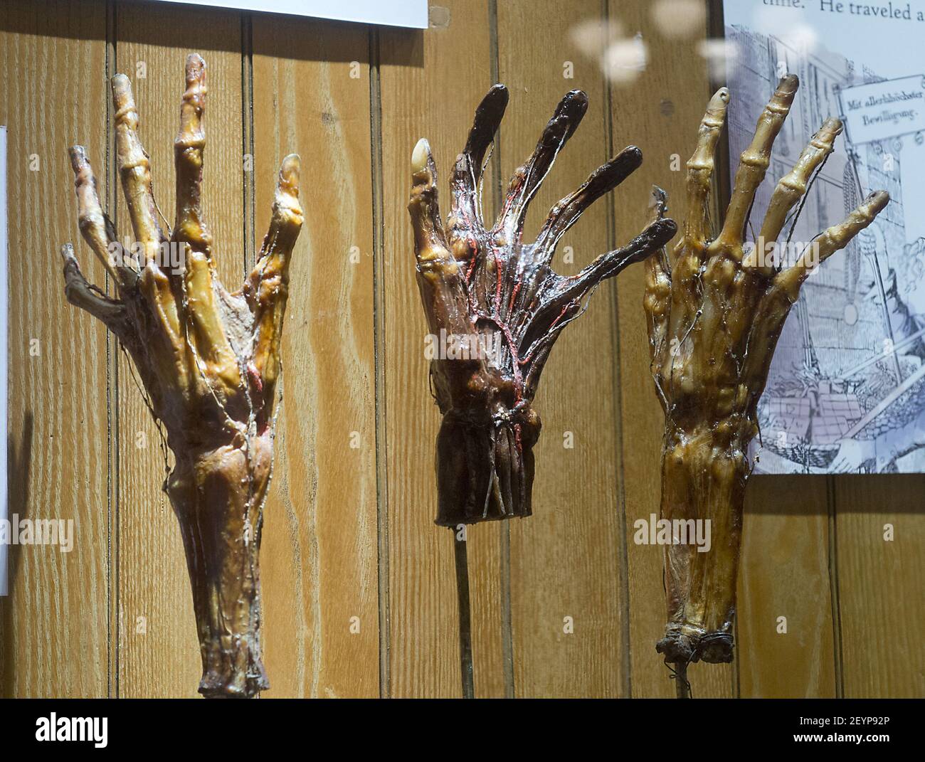 Dried hands are part of The Grimm's Anatomy exhibit at the Mutter ...