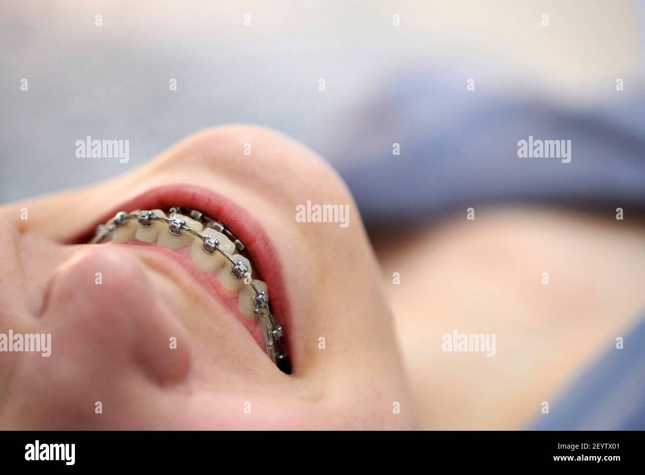 Smiling young woman with brackets on teeth close up. Metal self ...