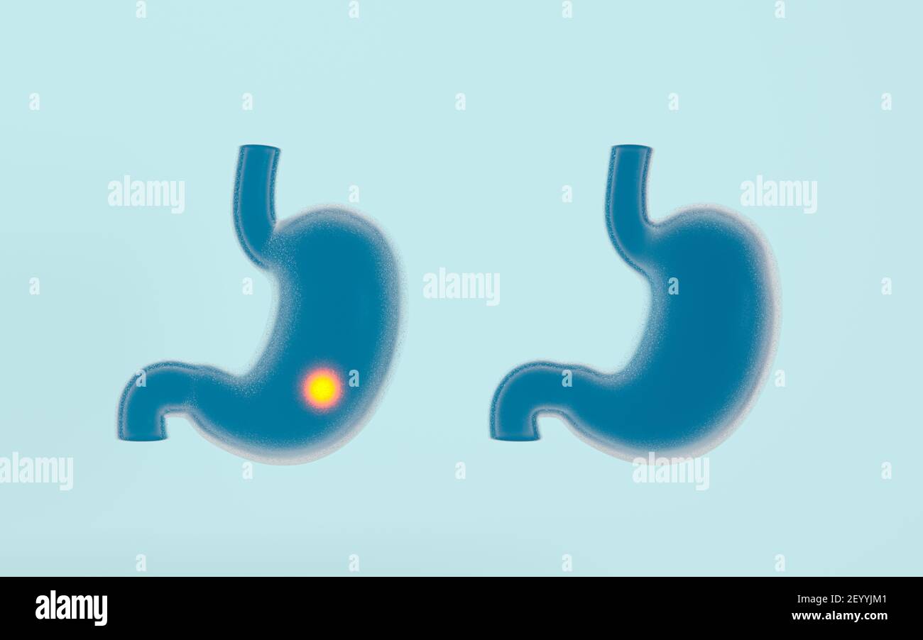 Human Internal Stomach with pain illness, 3d rendering. Computer ...