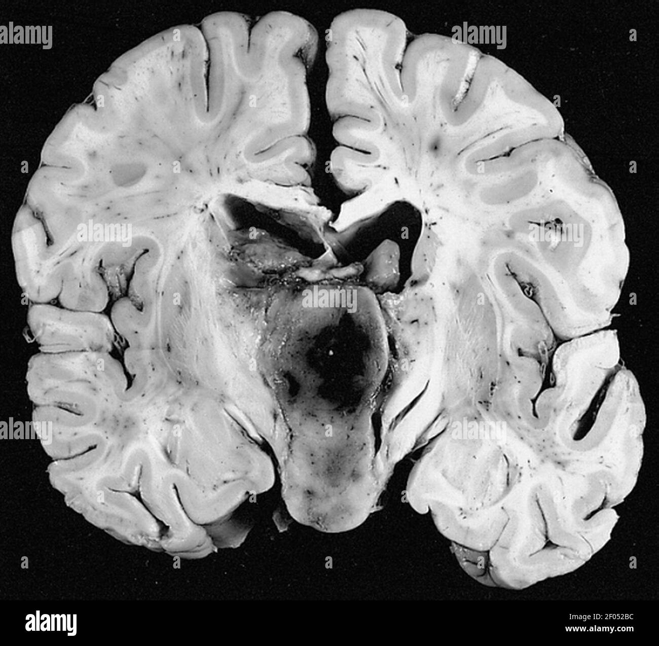 Pilocytic astrocytoma of the hypothalamic region Stock Photo - Alamy