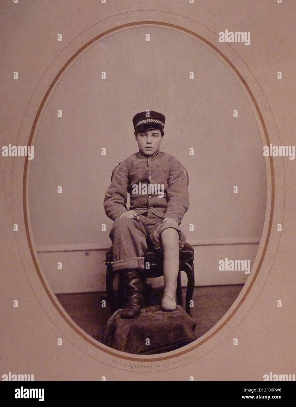 Pirogoff hi-res stock photography and images - Alamy