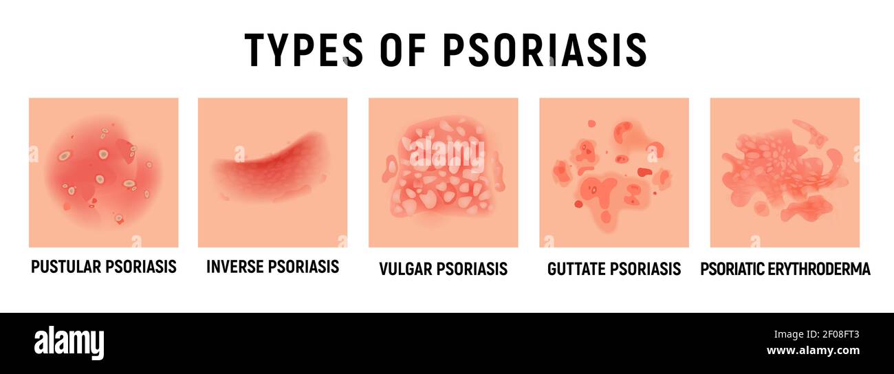 Psoriasis Skin Rash