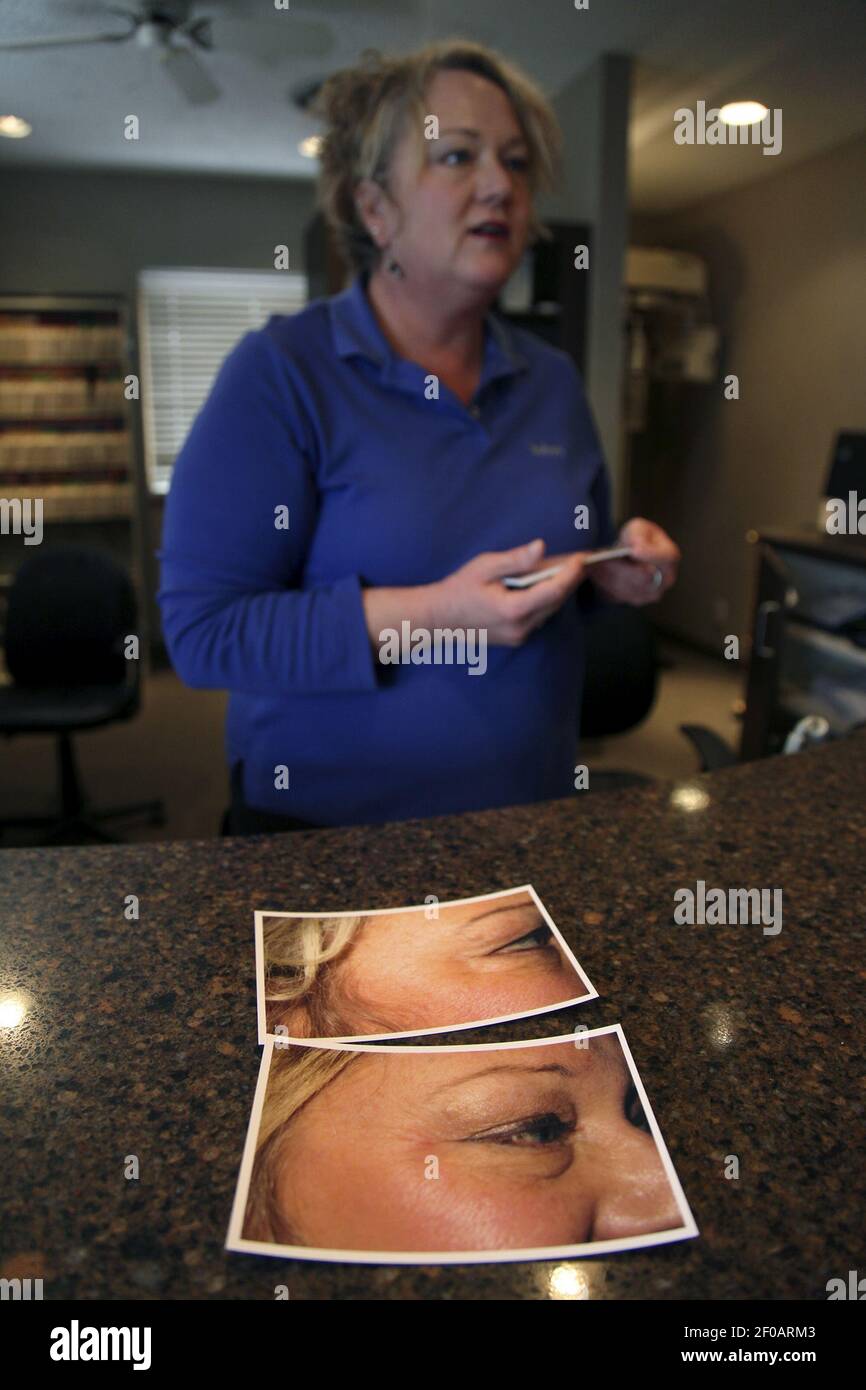 Dr. Michael Skadron's receptionist Robyn Nelson shows her before and ...
