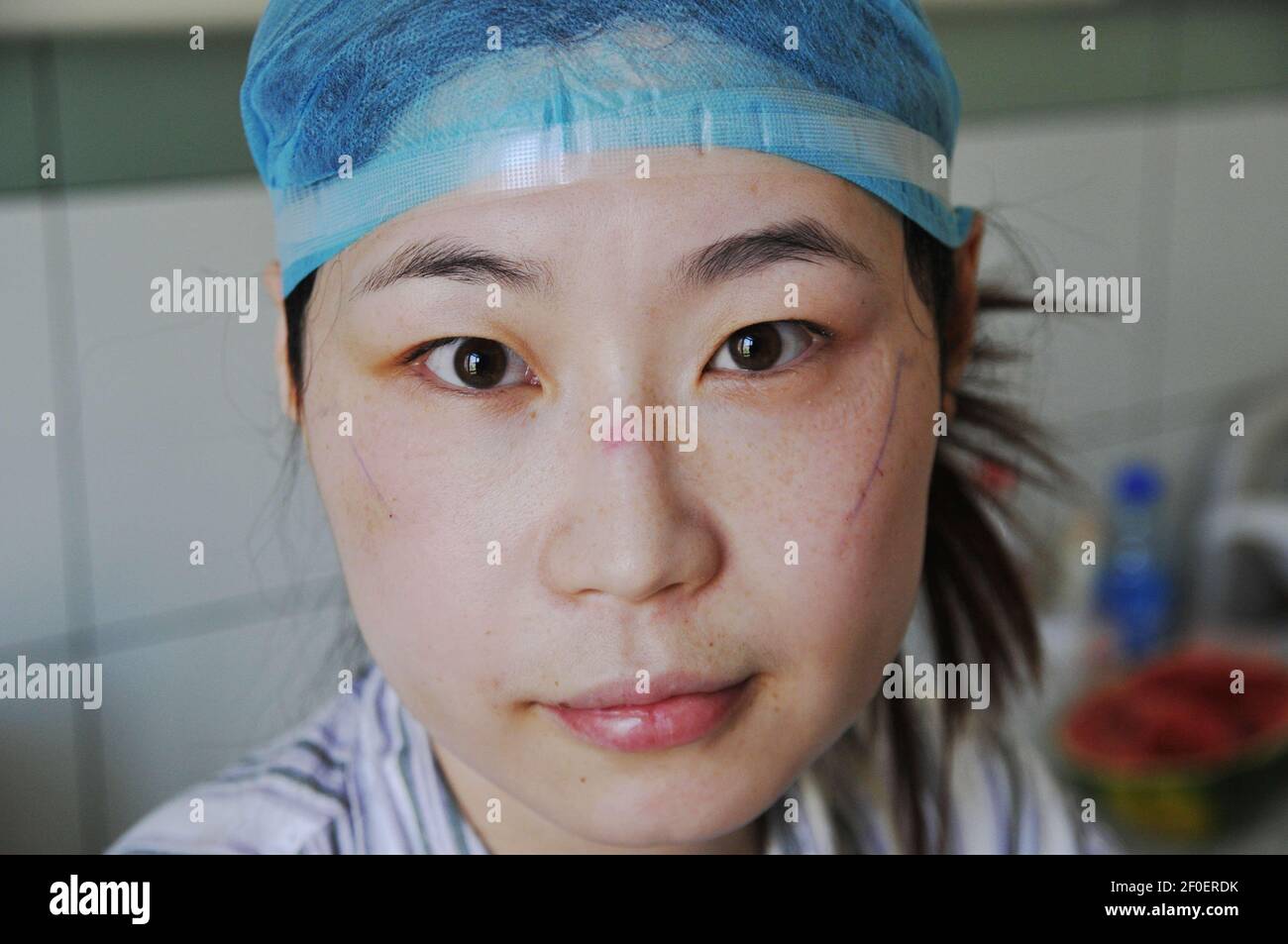 July 2009 - Beijing, China - Jia Qian, after her operation. Photo Credit: RaphaÃ¦l Fournier/Sipa ...