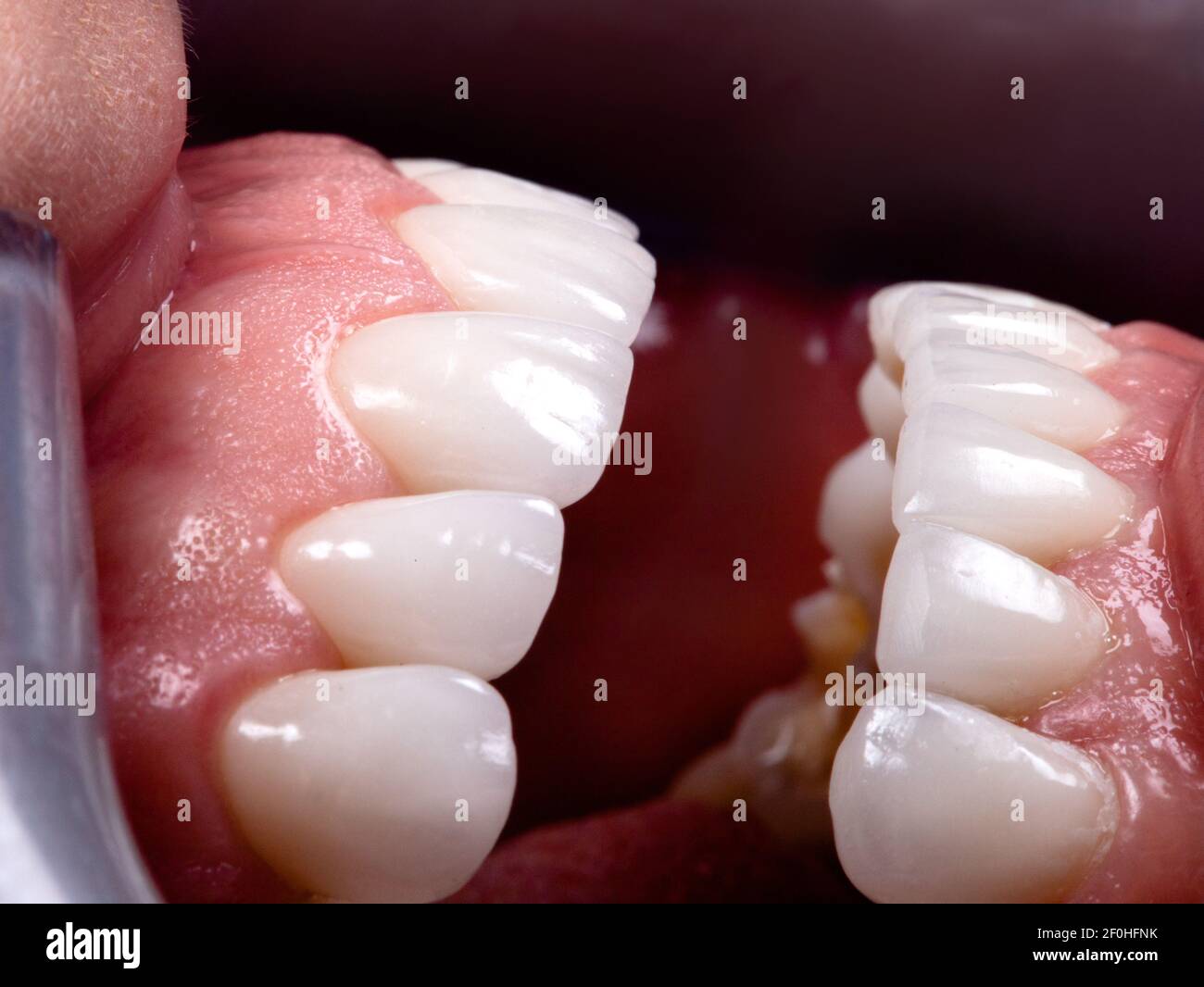 Perfect smile before and after bleaching procedure whitening of zircon ...