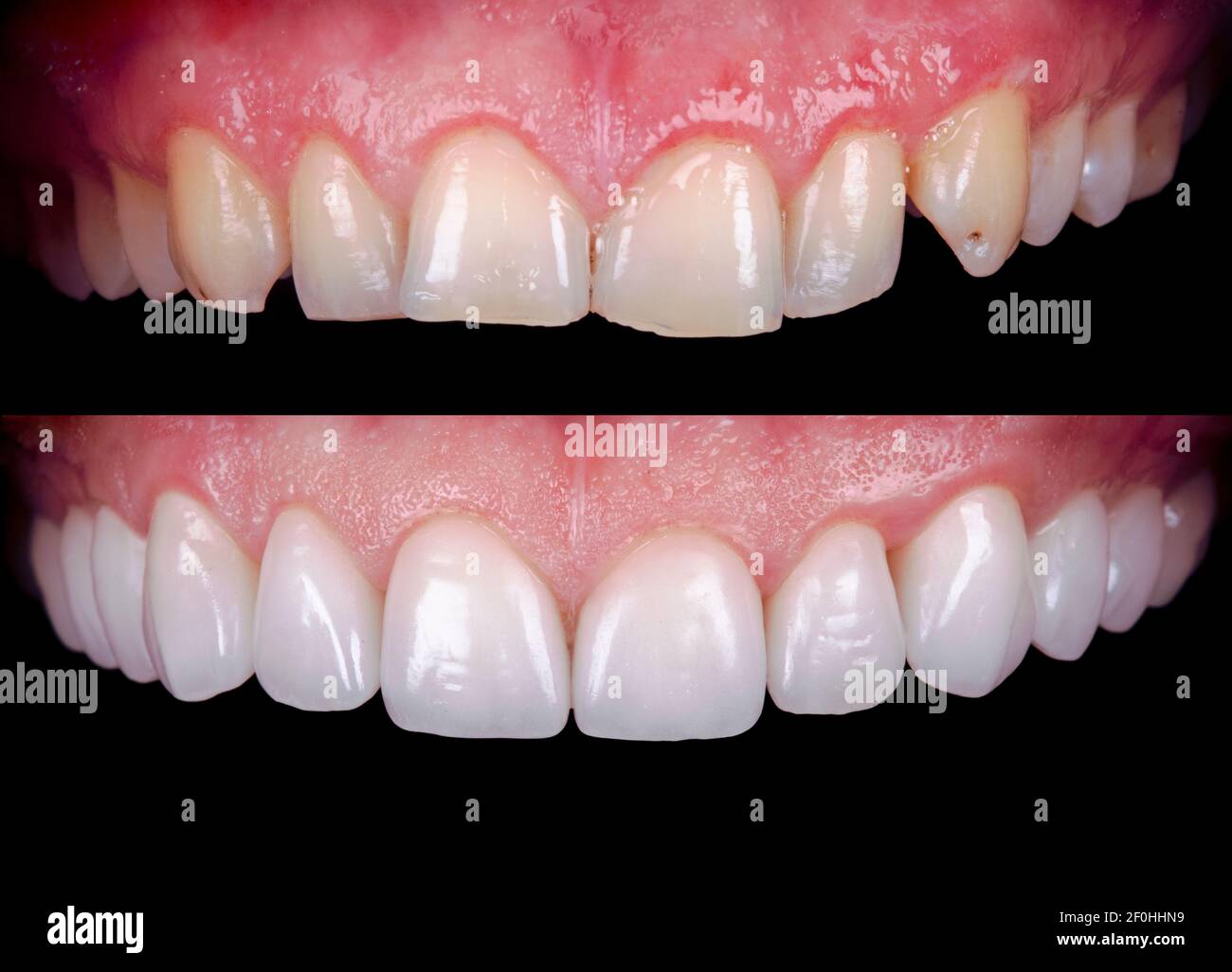 Perfect smile before and after bleaching procedure whitening of zircon ...