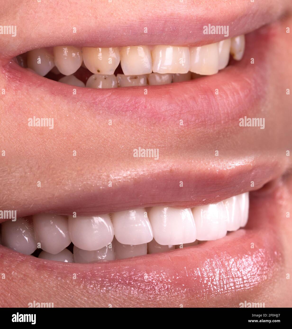 Dental implant before and after hi-res stock photography and images - Alamy