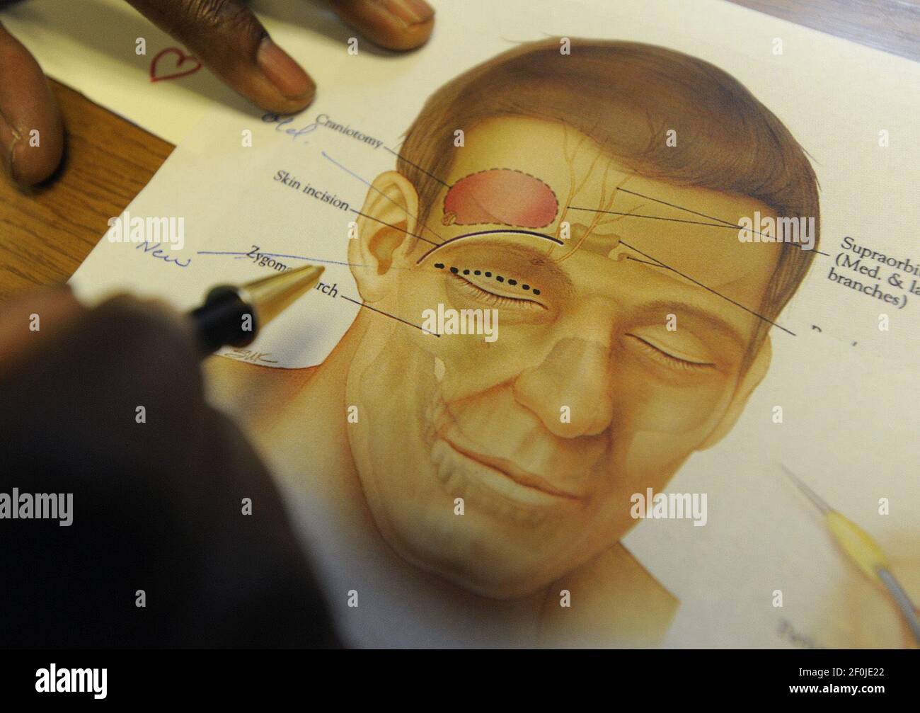 In this illustration, a dotted line indicates the new incision area ...