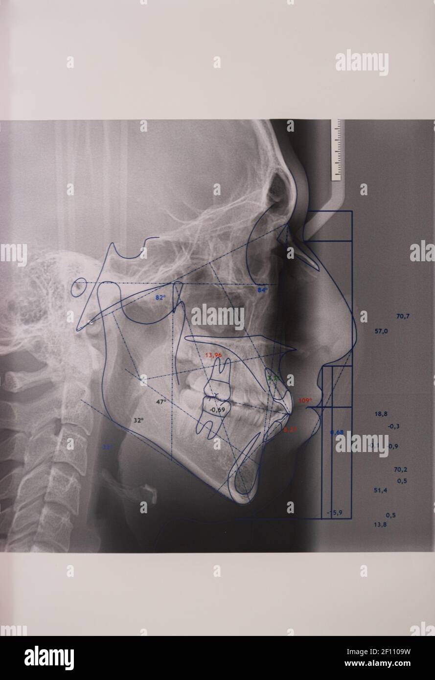 lateral cephalometry of a young man with dental measurements. dental x ...