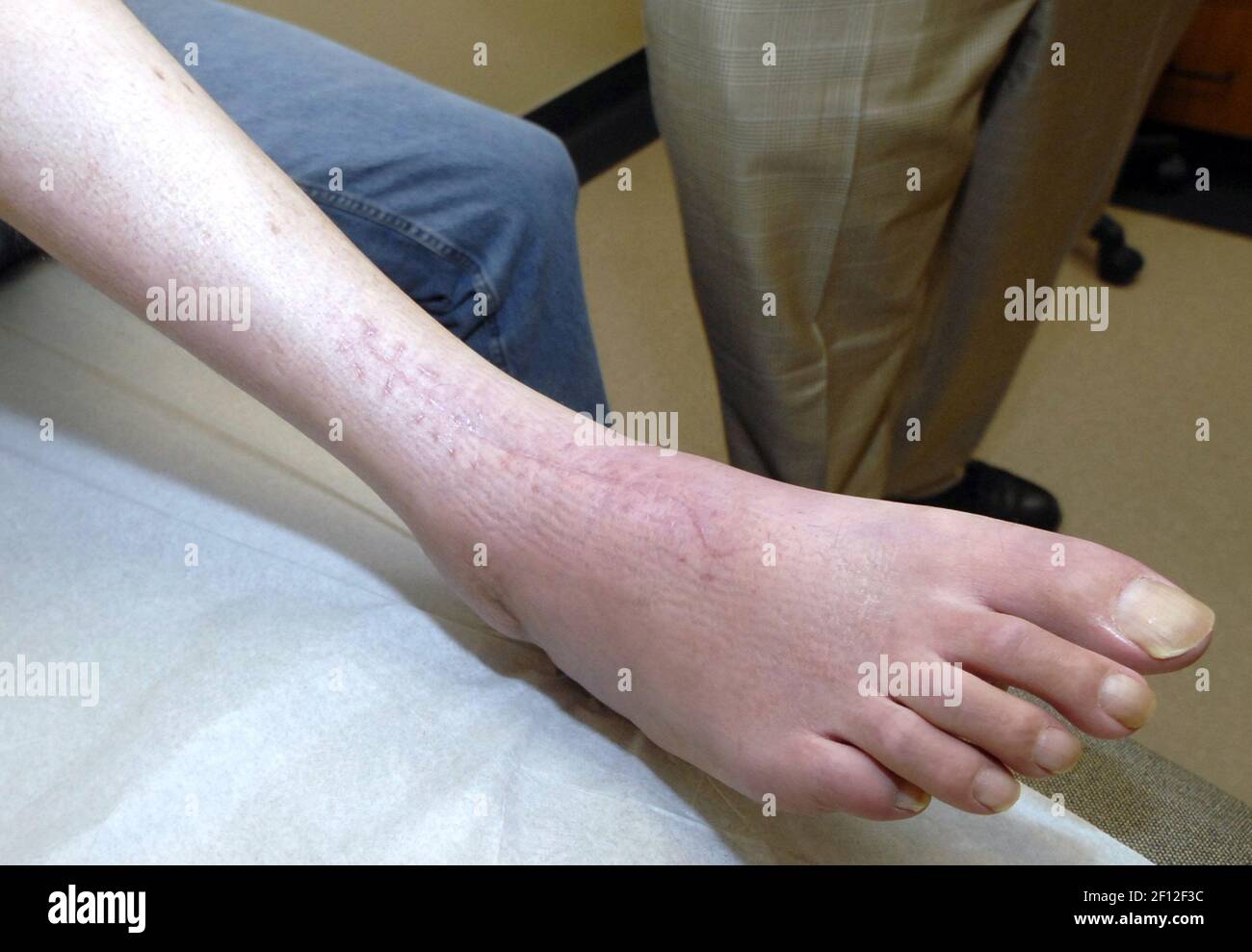 A close view shows the one of two incisions made for the ankle implant ...