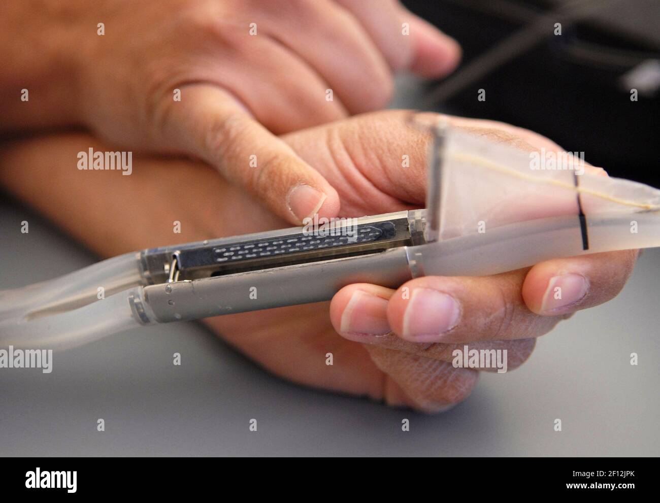 Dr. Sayeed Ikramuddin shows the surgical staple device used during ...
