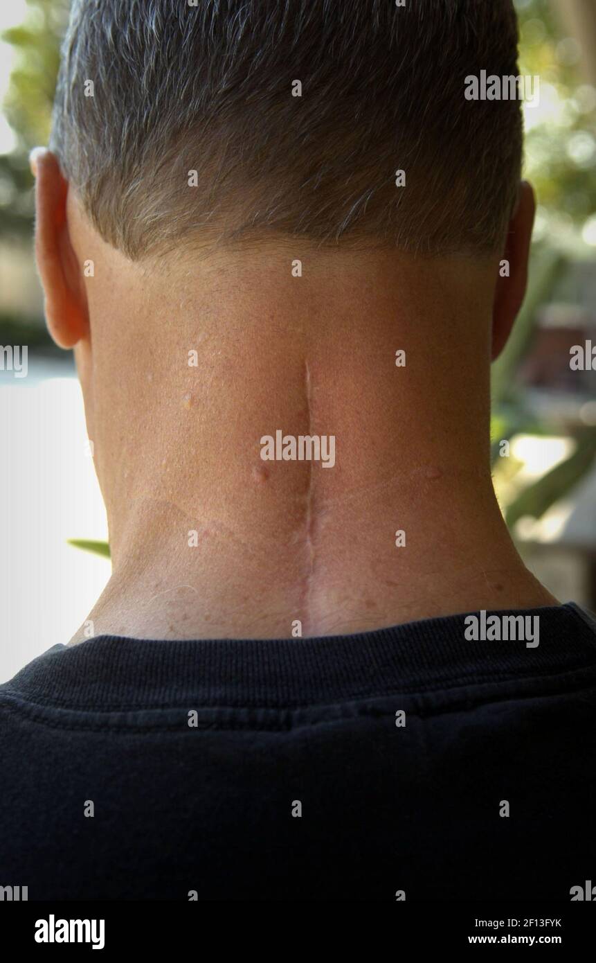 Fred Miller shows his scar from his neck surgery, July 15, 2008, in ...