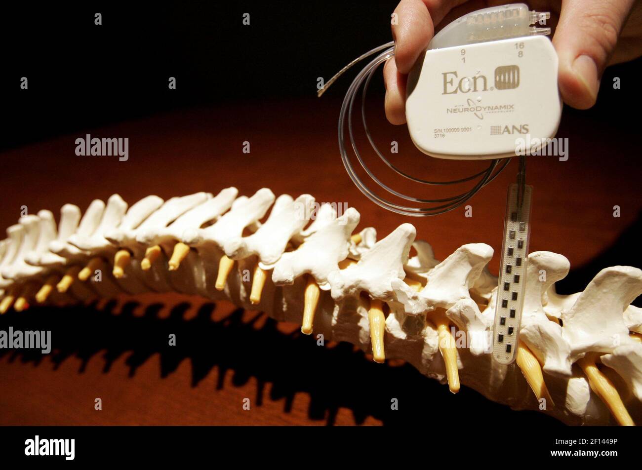 Rohan Hoare, Ph.D, displays the Eon Spinal Cord Stimulation System at ...