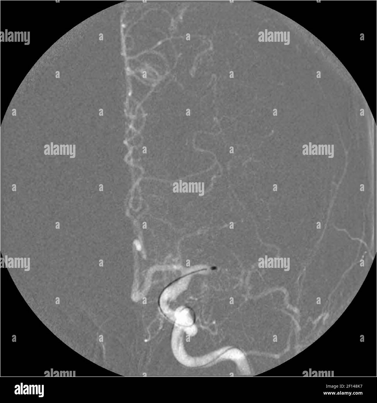 A CAT scan of Elizabeth Weiler's brain indicates the ultrasonic ...