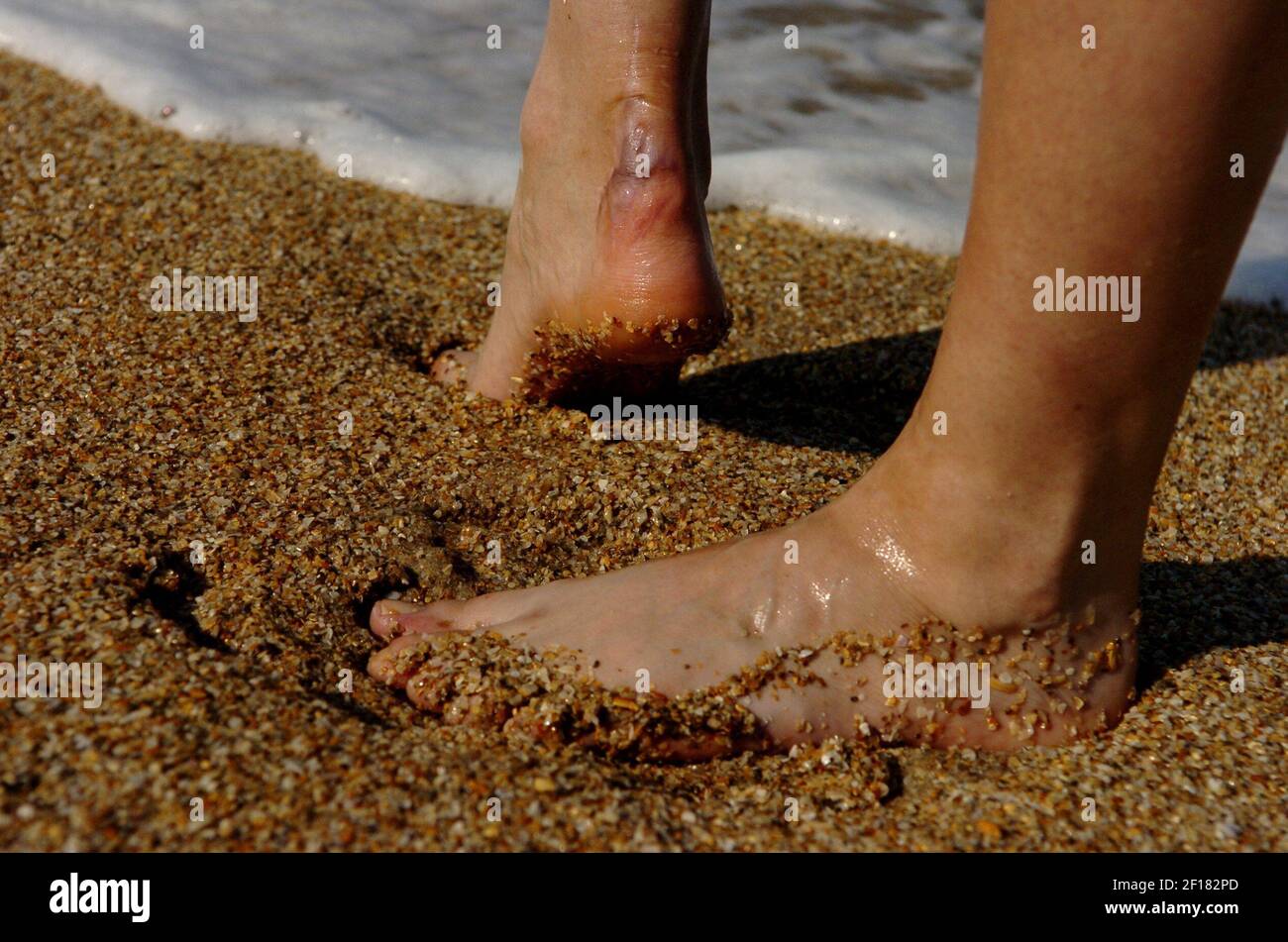 KRT LIFESTYLE STORY SLUGGED: HEALTH-SHARKBITE KRT PHOTOGRAPH BY SARA A ...