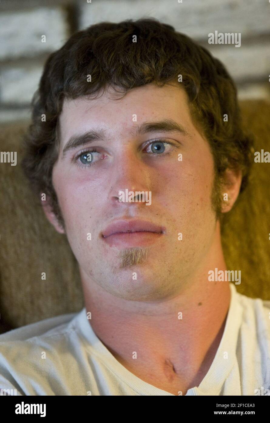 The piece of Chase Kear's skull that was removed during surgery to ...