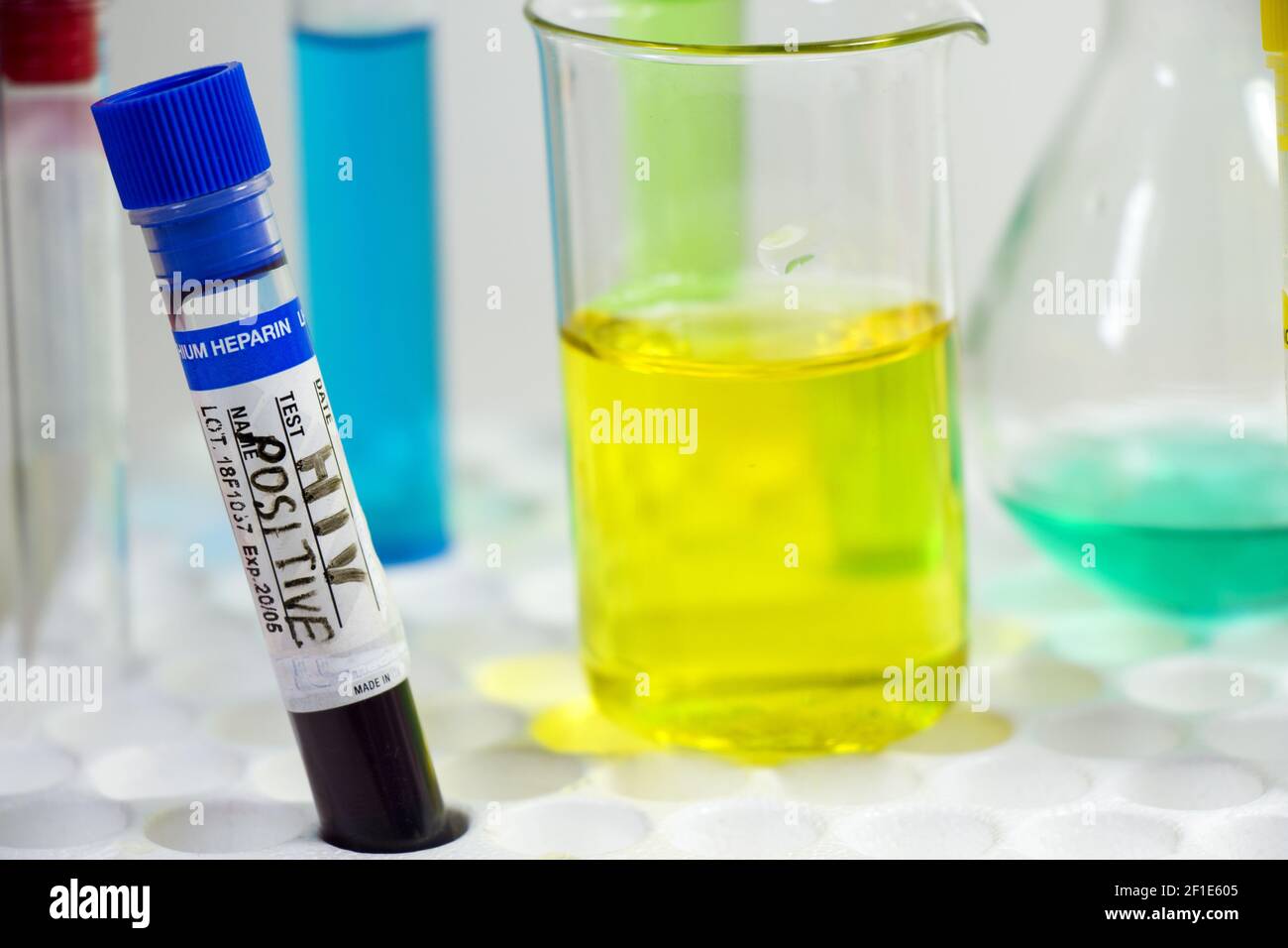A closeup of an HIV positive blood test tube and chemical beakers on ...