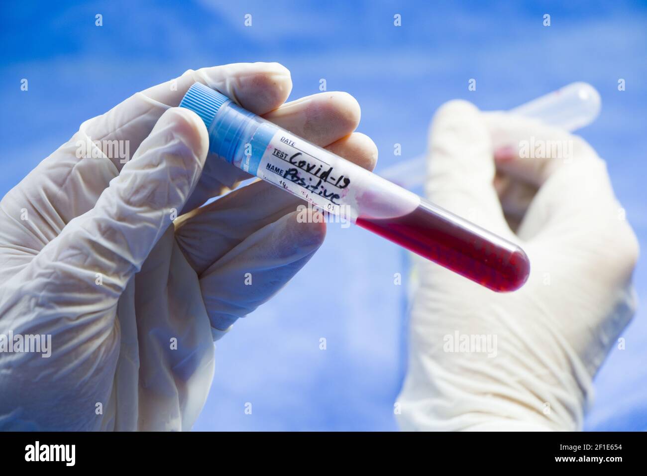 A closeup of a doctor in latex gloves holding a COVID-19 POSITIVE test ...