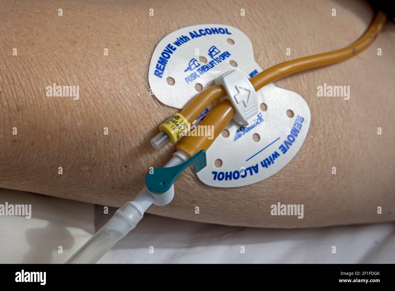 Catheter valve used for controlled draining of the bladder after a ...
