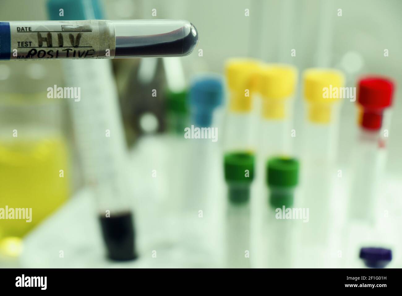 A closeup of an HIV positive blood test tube in the laboratory Stock ...