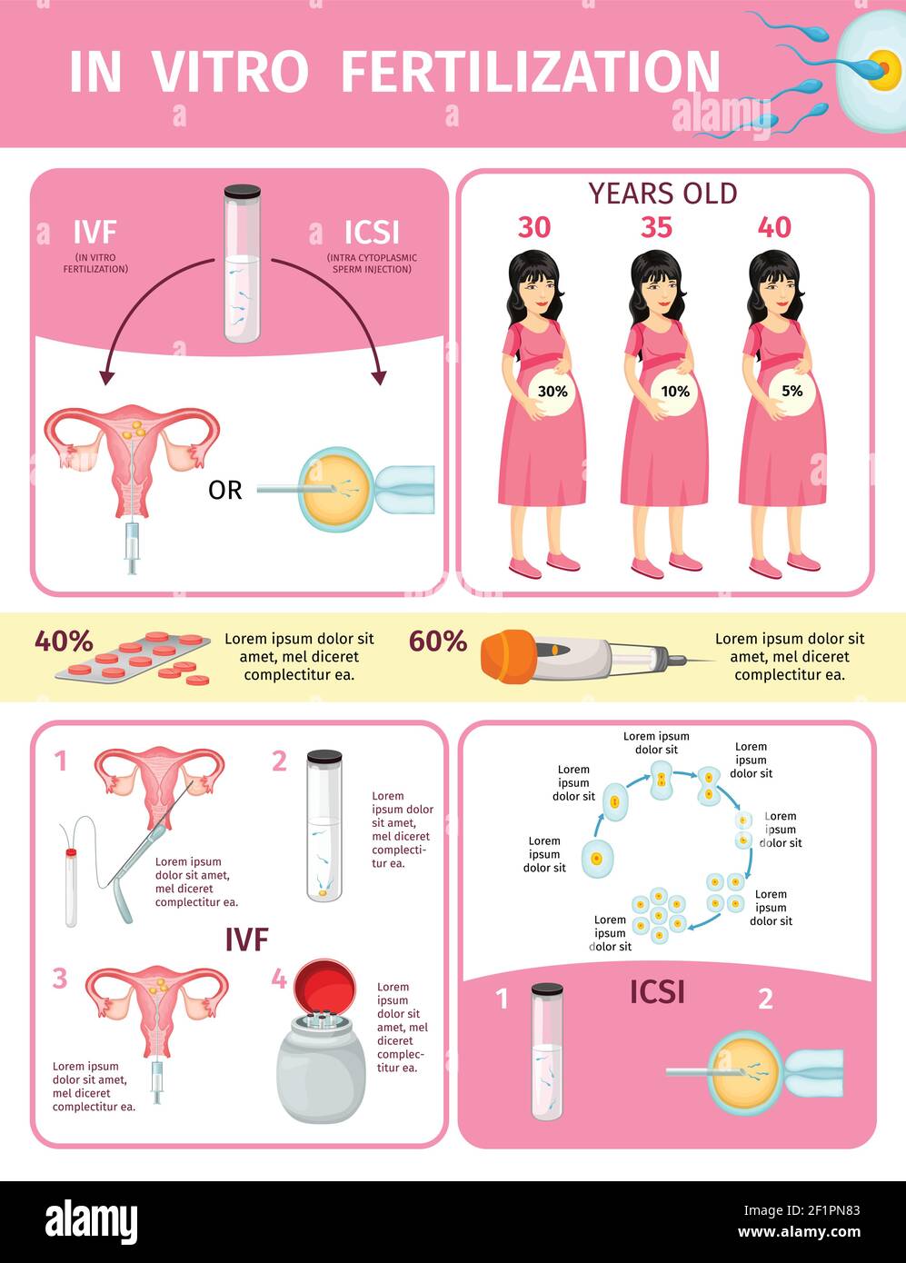 In vitro fertilization infographic concept with processes and procedures of artificial ...