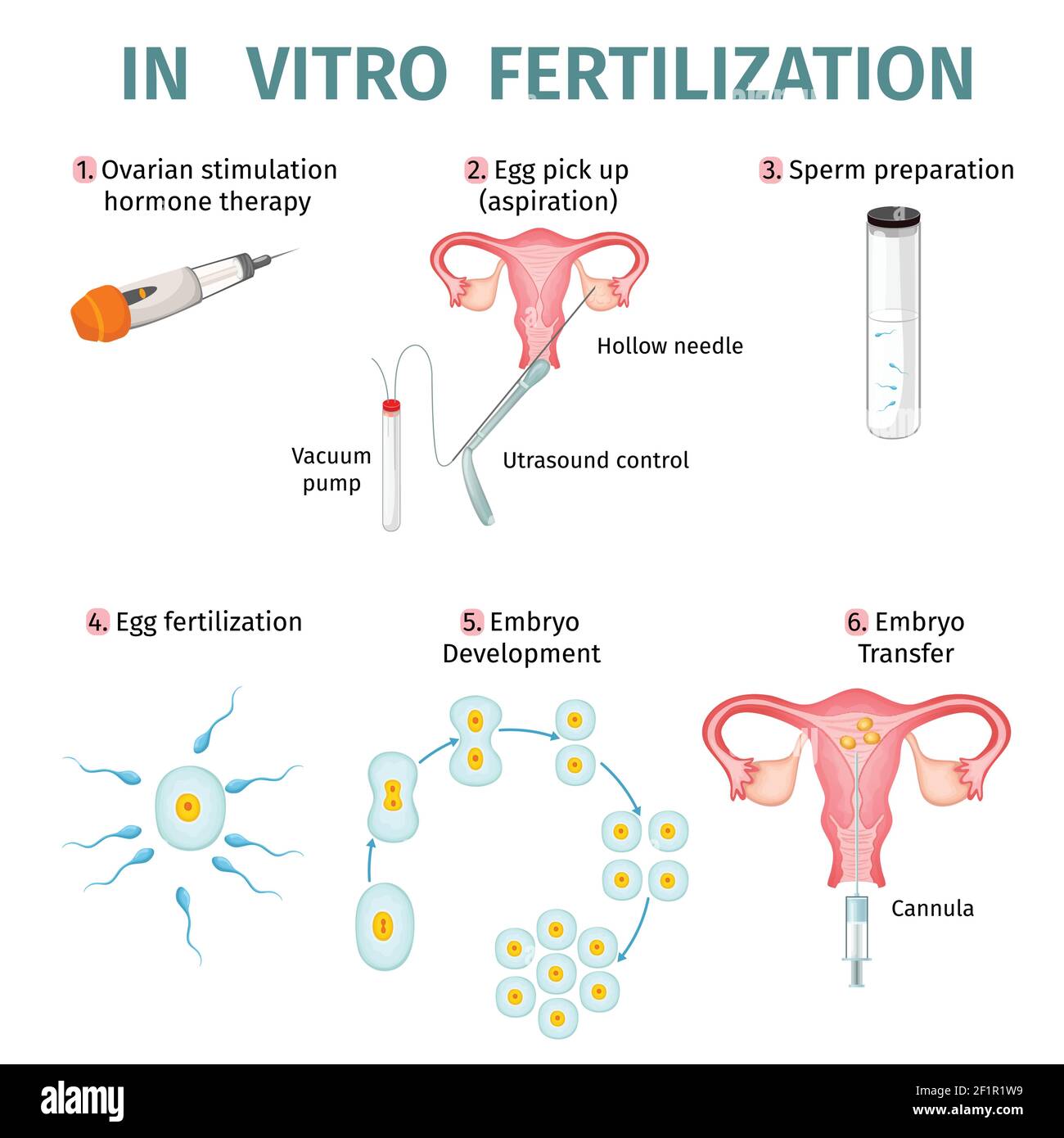 In vitro fertilization concept with steps and procedures of artificial insemination vector ...
