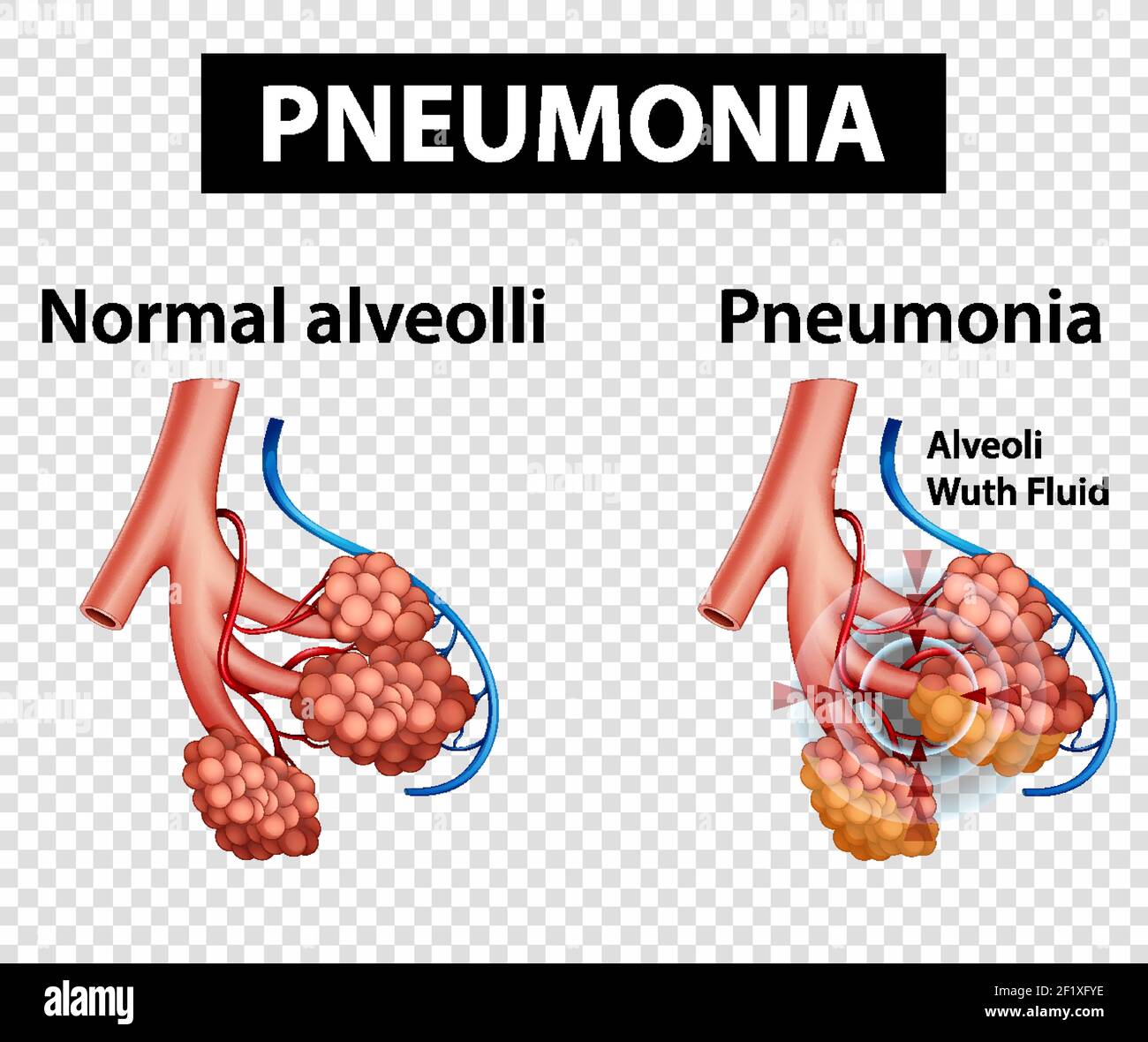 Diagram showing pneumonia on transparent background illustration Stock ...