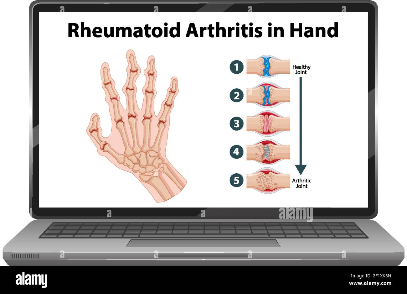 Rheumatoid arthritis symptoms on hand on laptop screen illustration ...