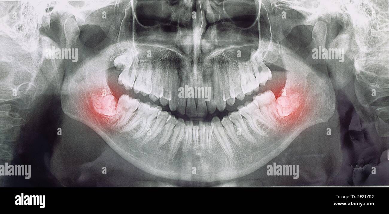 different types of wisdom teeth problems concept, problem teeth X-ray ...