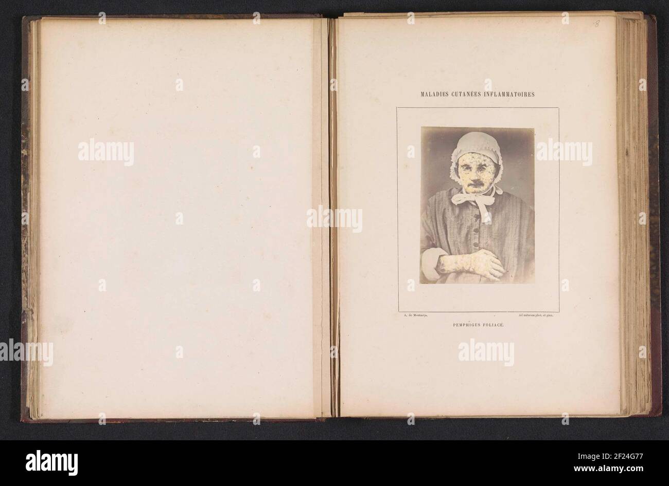 Pemphigus foliacé hi-res stock photography and images - Alamy Pemphigus foliacé hi-res stock photography and images - Alamy