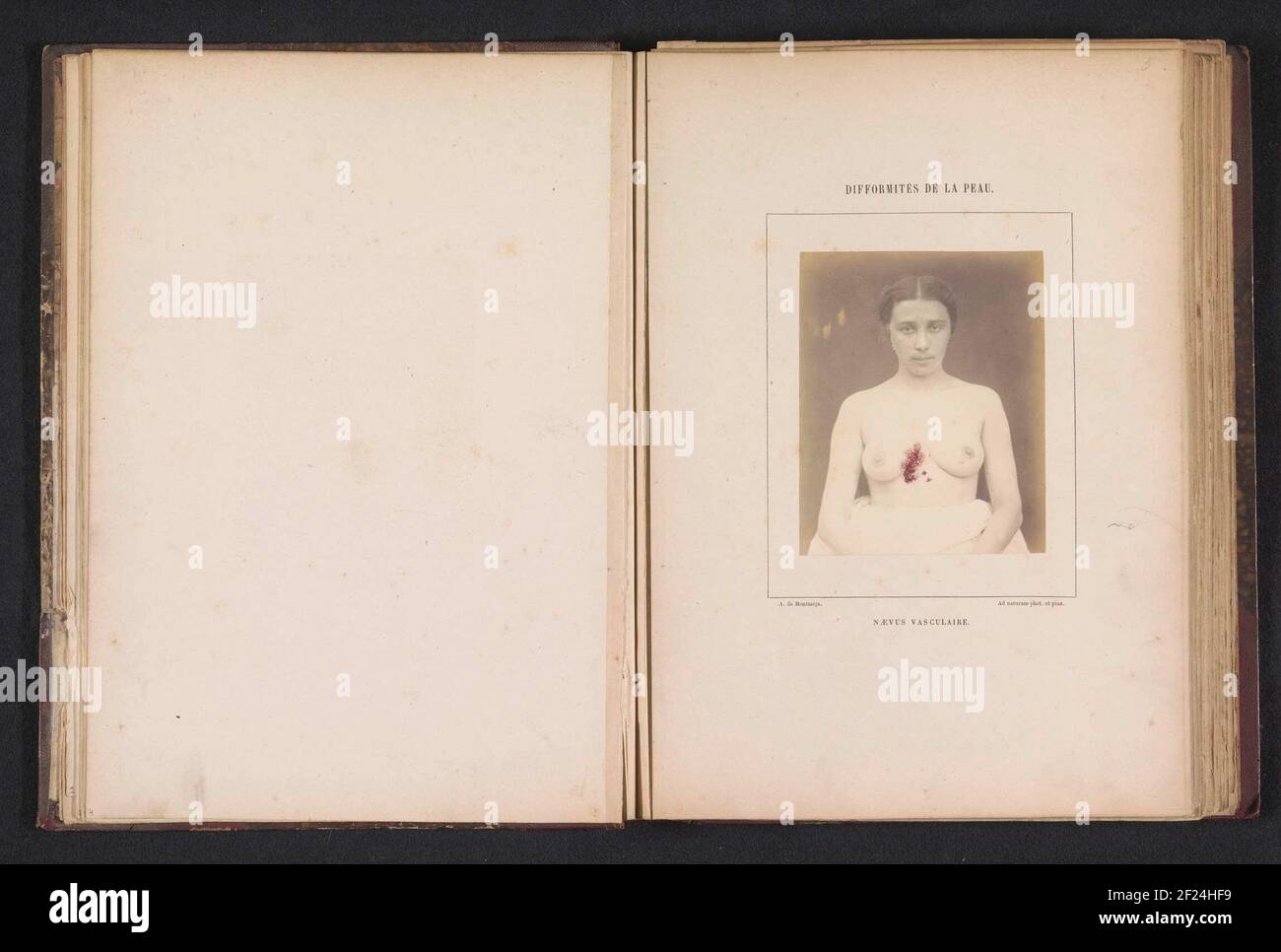 Vascular naevus hi-res stock photography and images - Alamy