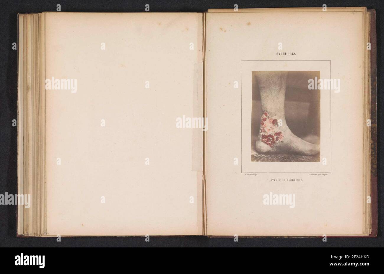 Ignay skin rash on a foot caused by syphilis; Syphilide Ulcéreuse Stock ...