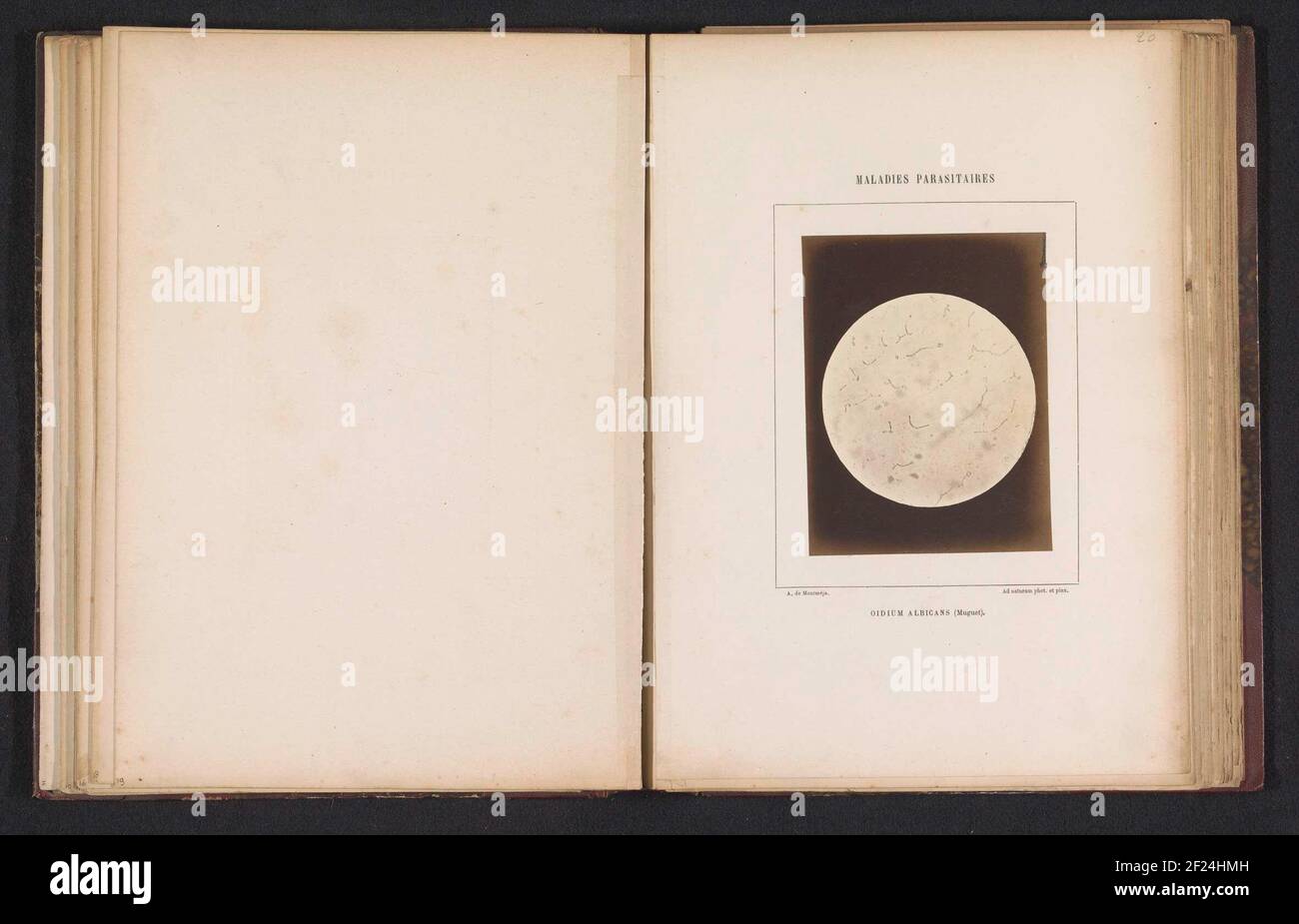 Microscope intake of presumably candida albicans; Oidium Albicans ...
