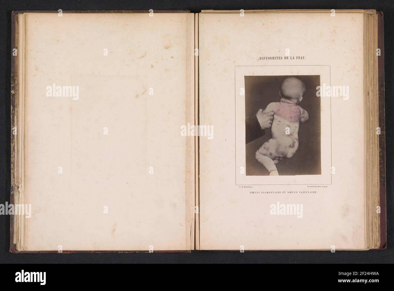 Baby puts Gepigmenteerde Naevi vascular Naevi; Pigmenta Naevus and ...