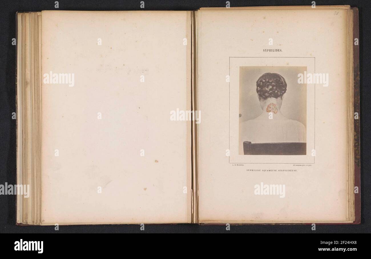 Woman with skin rashes in her neck caused by syphilis; Syphilide ...