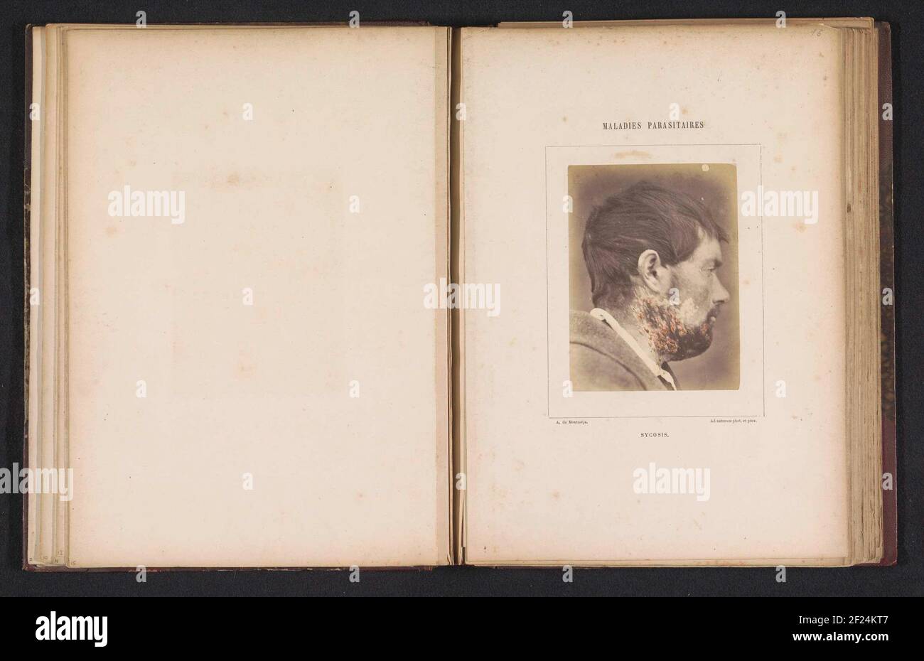 Sycosis barbae hi-res stock photography and images - Alamy