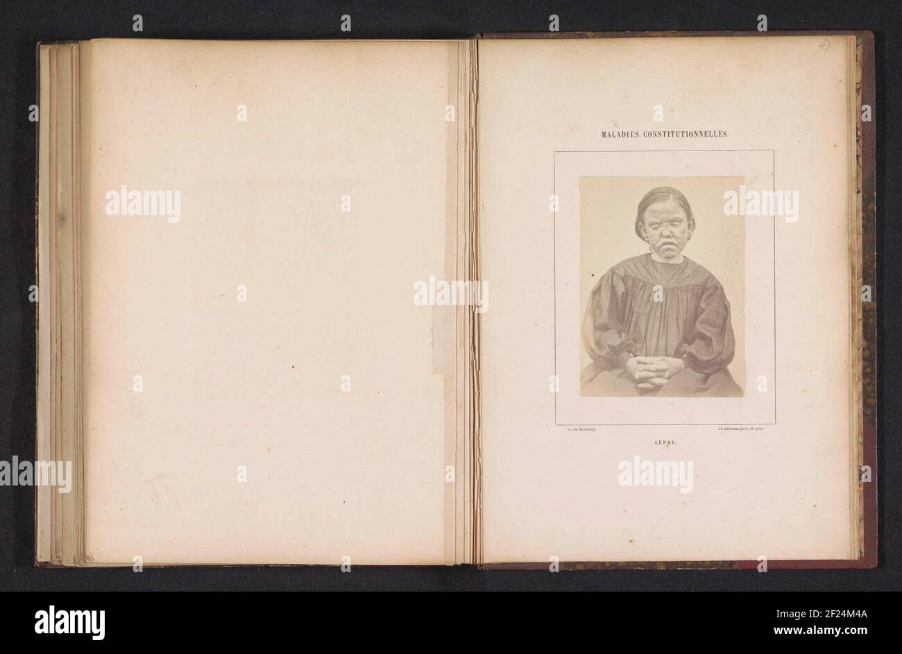 Woman leprosy hi-res stock photography and images - Alamy