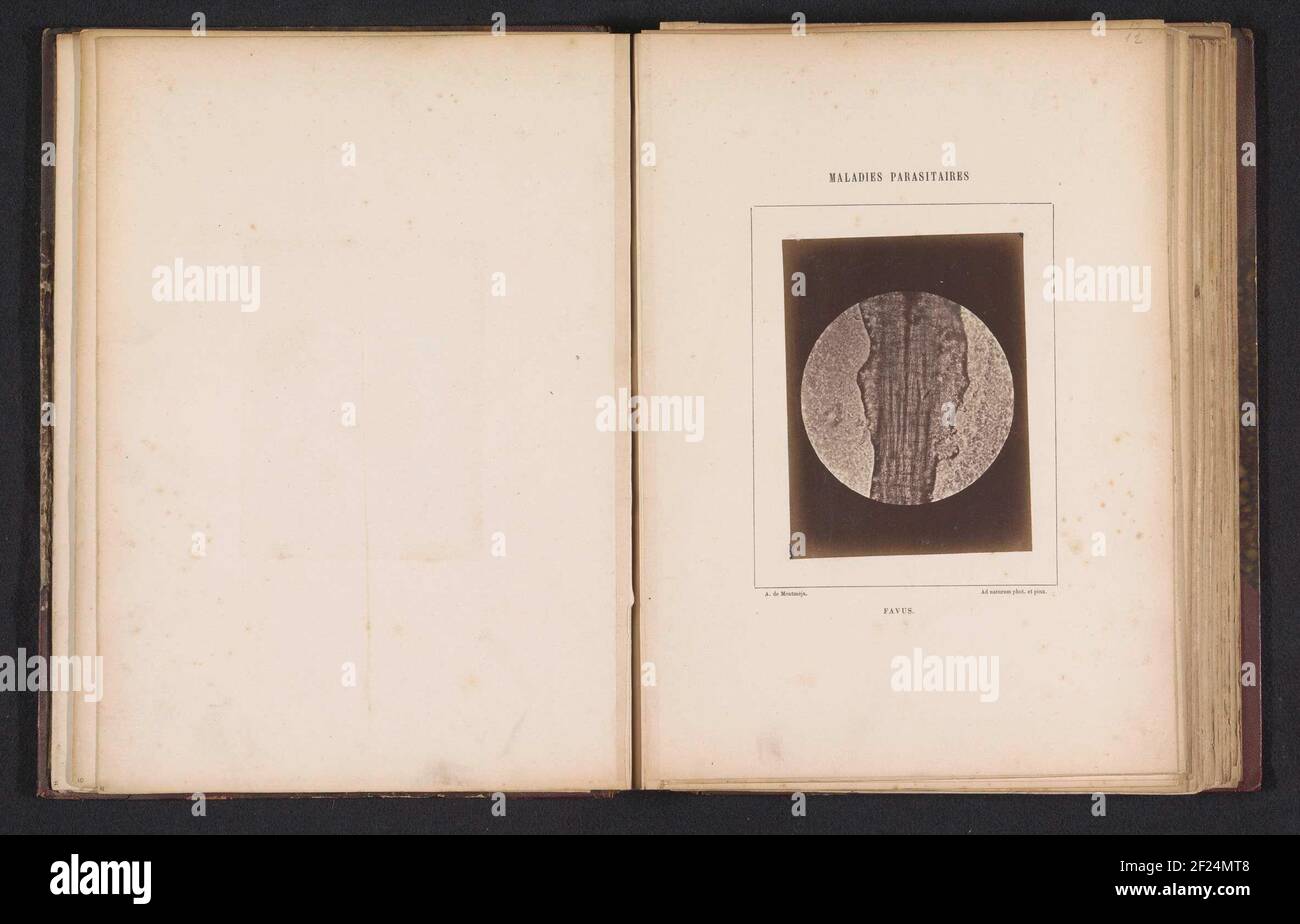 Microscope absorption of favus disease; Favus Stock Photo - Alamy