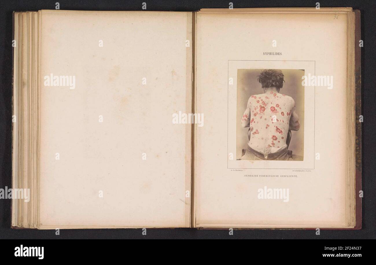 Man with skin rashes caused by syphilis; Syphilide tuberculeuse ...