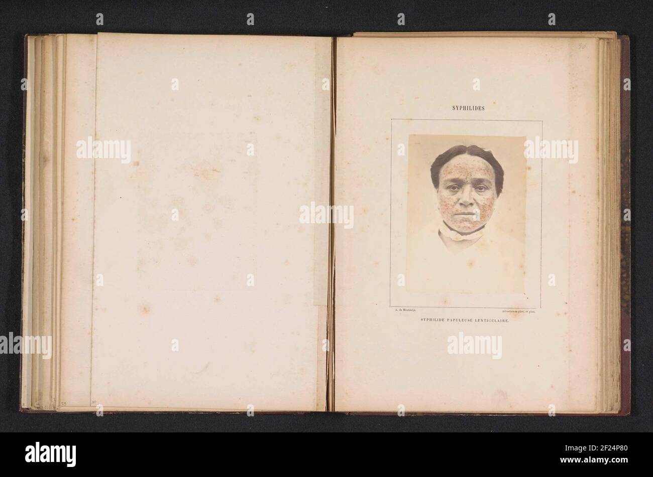 Skin rash caused by syphilis; Syphilide papuleuse lenticular Stock ...