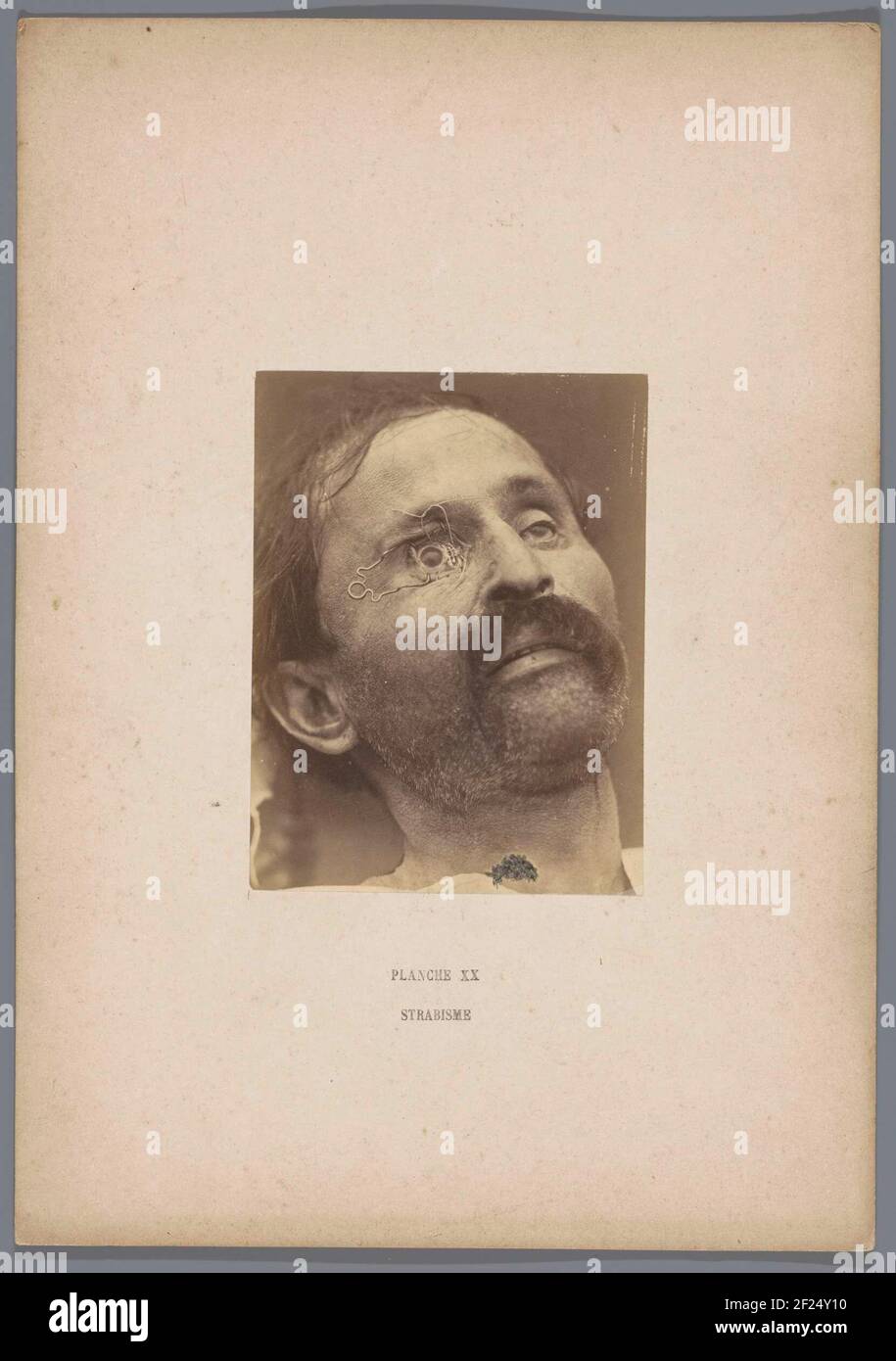 Patient with an open eye for an operation for sketch (Strabismus ...