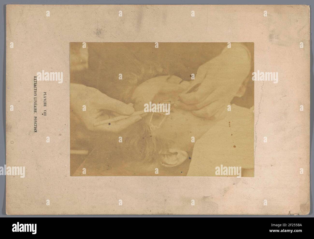 Removing cataract during an eye surgery by means of a puncture ...