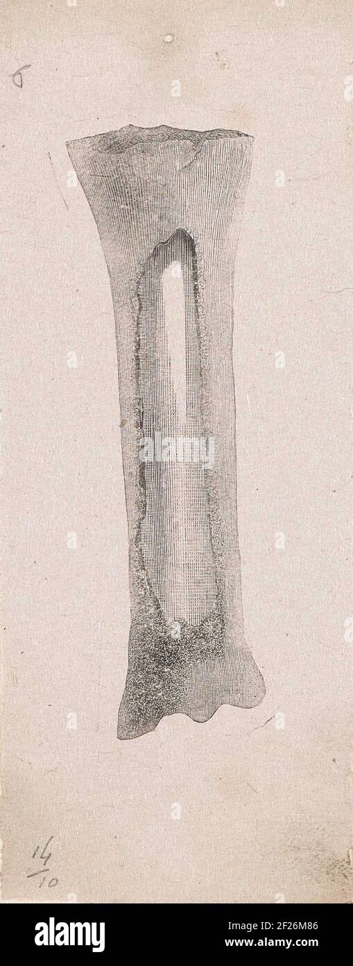 Human bone deviation hi-res stock photography and images - Alamy