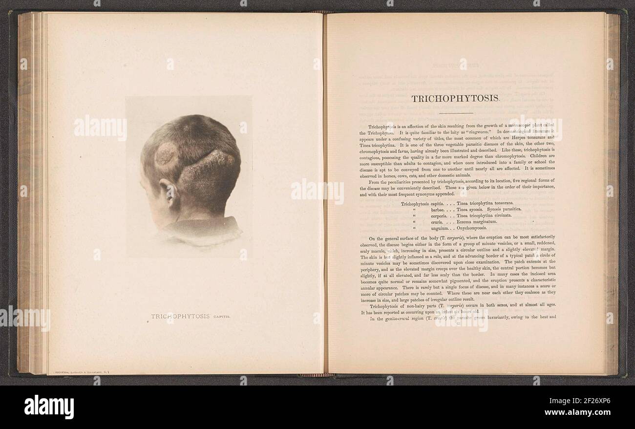 Patient suffering from the skin disease 'trichophytosis capitis ...