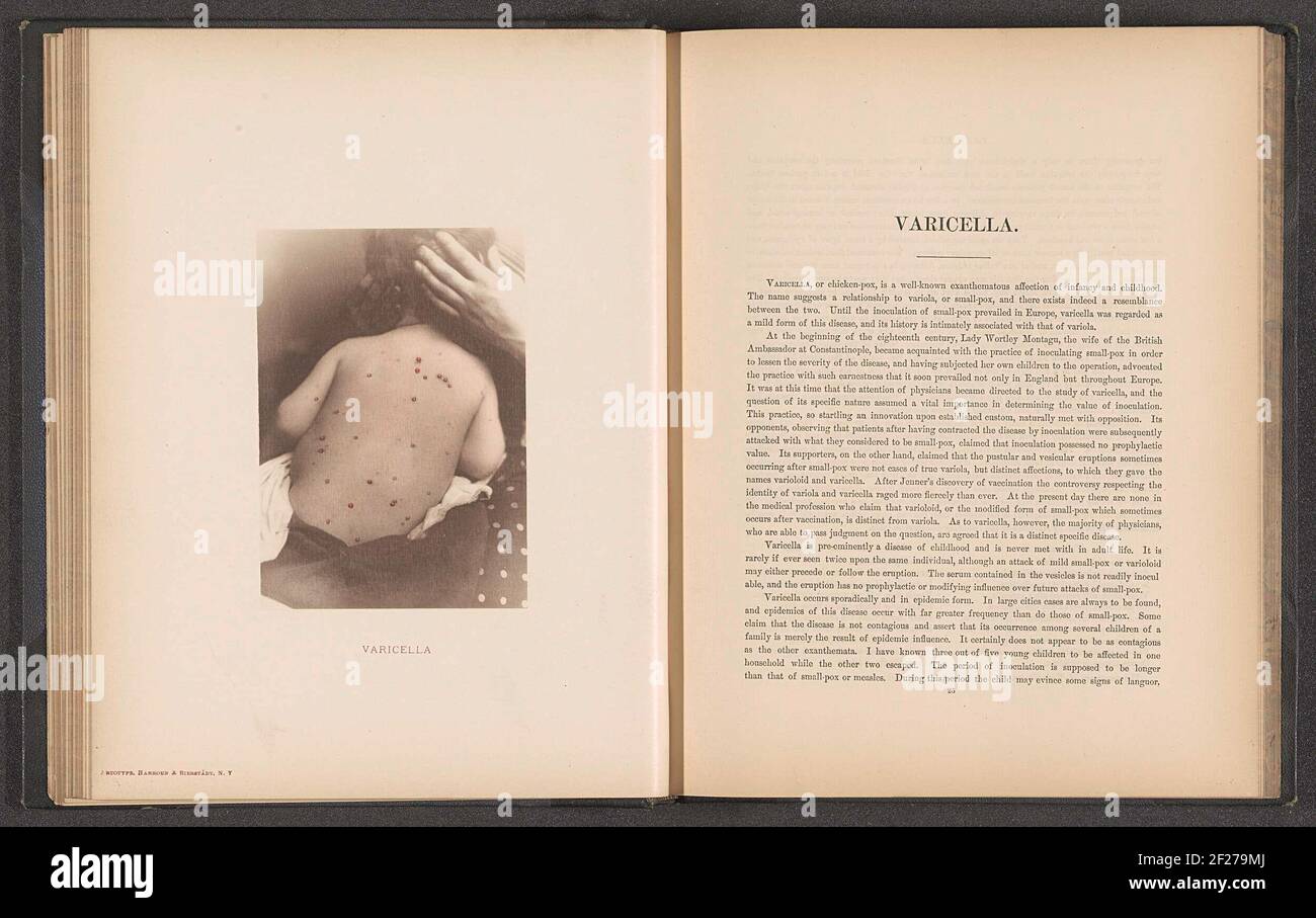 Patient suffering from the skin disease 'varicella'; Varicella Stock ...